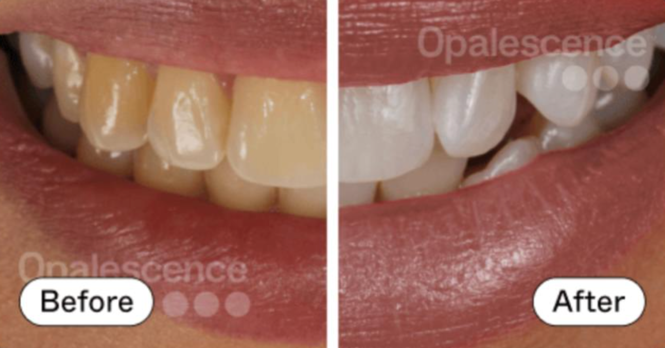 Opalescence Boost Teeth Whitening In Florida